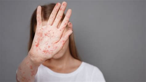 The Current Measles Outbreak Has Hit A New High Totalnews