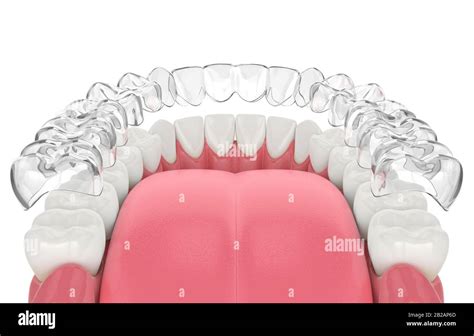 3d Render Of Invisalign Removable And Invisible Retainer With Lower Jaw Over White Background