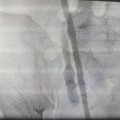 Intraoperative Retrograde Ureterography Showed That The Ectopic Ureter