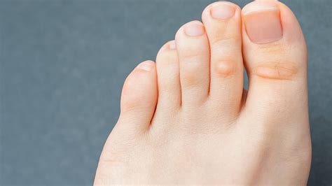 Can Foot Corns Go Away On Their Own Hot Sale