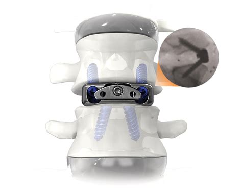 Dyna Link® Life Spine