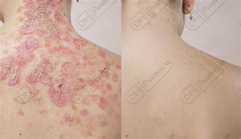 Купить крем от псориаза ПсоНикан в Москве цена фото и отзывы