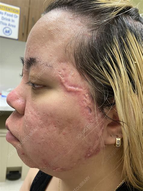 Pyoderma Gangrenosum Stock Image C060 3859 Science Photo Library