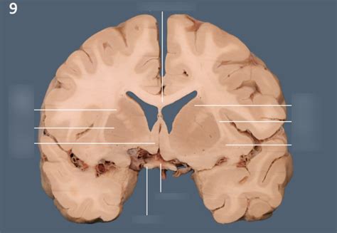 Coronal Brain Section 1 Diagram Quizlet