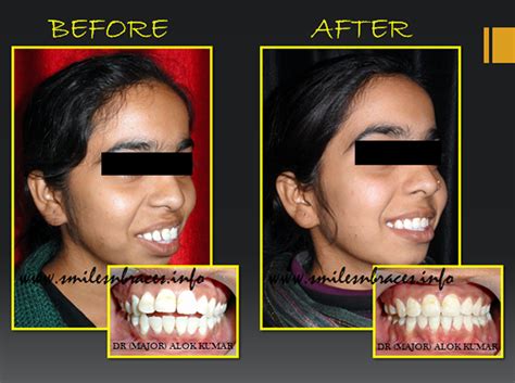 Midline Diastema With High Frenum Corrected Smilesnbraces