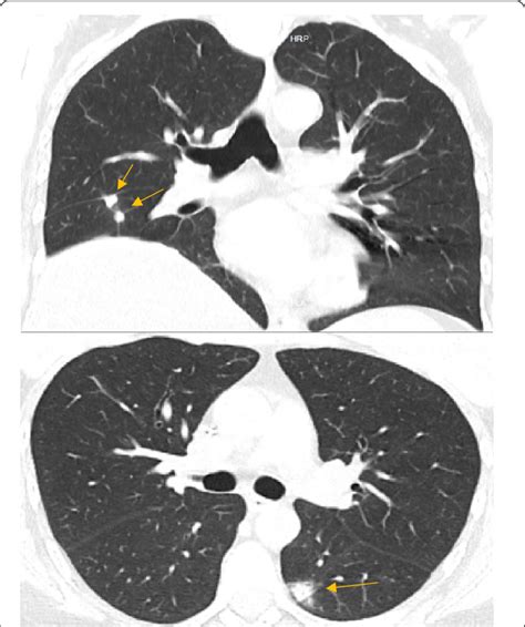 High Resolution Chest Computed Tomography Showing Bilateral Solid