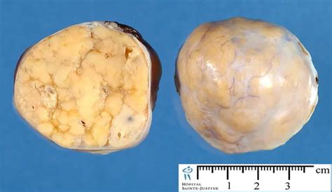 Juvenile Granulosa Cell Tumor