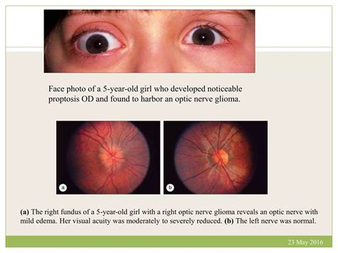 Optic Pathway Glioma Pptx