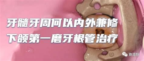 C Root Sp小摘 欣赏一下程庚医生的根管充填案例吧！ 知乎