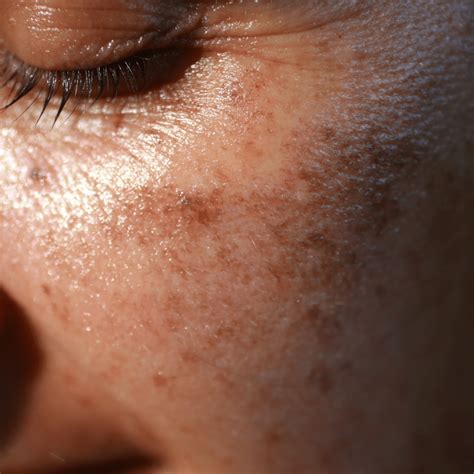 Skin Pigmentation Disorders Ovviovita