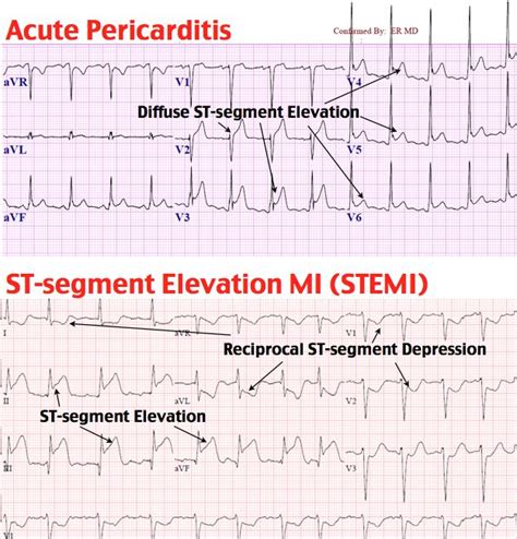 Pericarditis Vs Stemi Ecg Early Repolarization Or Anterior Stemi Ecg