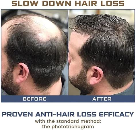 Zoku Hgp Hair Tonic Spray Polygonum Multiflorums Hair Growth Serum For Hair Loss And Hair