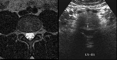 Mri And Usg View Of Circular Protrusion Of The Ivd Arrow Download