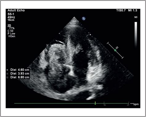 Large Heterogeneous Mass In The Right Chambers A Case Report In Cardio