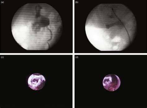 Diagnostic Ureteroscopy Abdominal Key