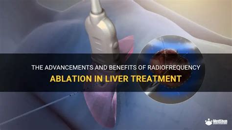 The Advancements And Benefits Of Radiofrequency Ablation In Liver Treatment Medshun