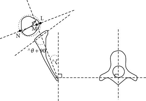Schematic Drawing Showing The Method Of Calculating Glenoscapular Angle Download Scientific