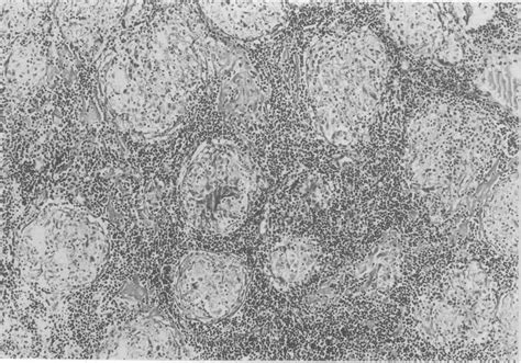 Mediastinal Lymph Node Biopsy Showing Non Caseating Giant Epitheloid