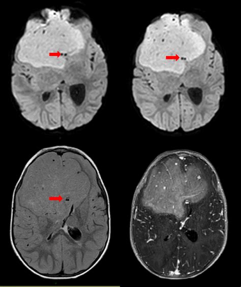 Dwi T Inversion Recovery And Enhanced T Mr Images After Months