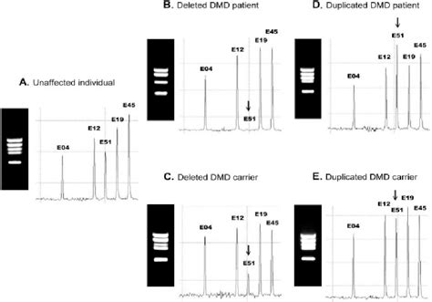 Figure 4 From Quantitative Assay Of Deletion Or Duplication Genotype By Capillary