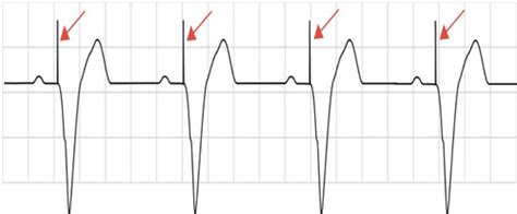 Pacemaker Rhythms Flashcards Quizlet