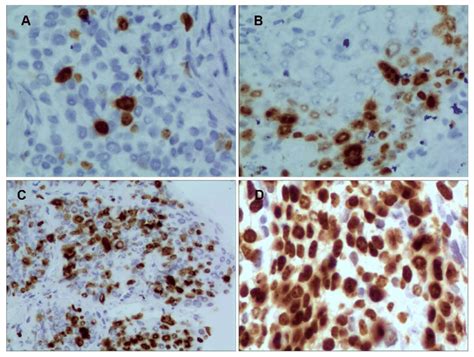 Immunohistochemical Staining Of Ki 67 Expression In Advanced Lung Scc