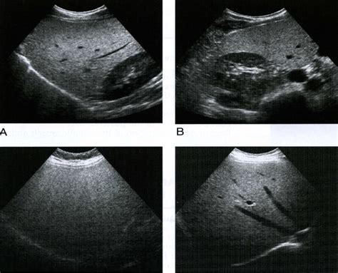 A B C D Showing Ultrasound Images Of Diffuse Fat Spectrum Of Appearance Download Scientific
