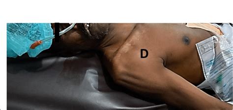 Right Shoulder Anteroinferior Atraumatic Dislocation D Download