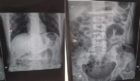 Plain Abdominal Ap Radiograph Shows Foreign Body In The Stomach At The