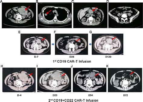 Figure 4 From Dual Specific Cd19cd22 Targeted Chimeric Antigen