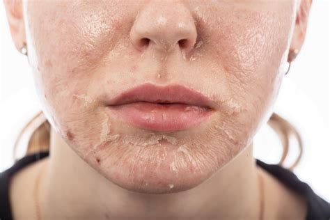Yosun peeling soyulma kaç gün sürer