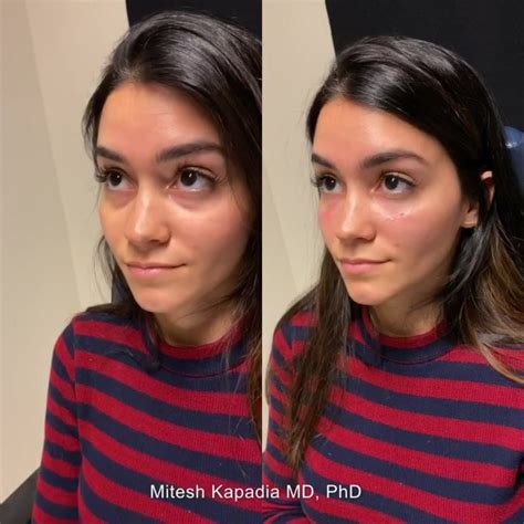 Before And Immediately After Tear Trough Correction In A Woman In Her