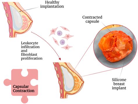 Capsular Contracture Artofit