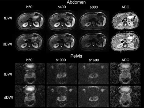 Figure 3 From Comparison Between 3 Scan Trace And Diagonal Body Diffusion Weighted Imaging