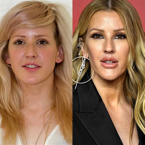 9 Celebrities Before And After Dramatic Lip Fillers Evie Magazine