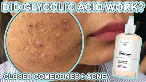 Alpha Hydroxy Acid For Acne Prone Skin At Sarah Gooding Blog