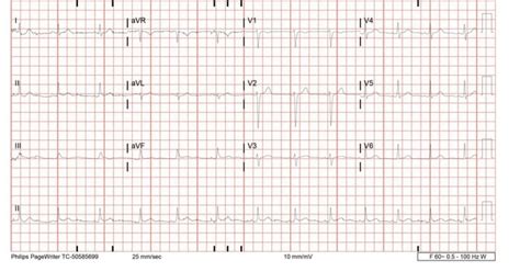 Subtle St Elevation R Readmyecg