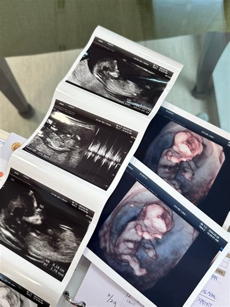 임신기록 임신12주차 초음파 일산 허유재병원 1차 기형아검사 입체초음파 성별힌트 장꾸맘각도법 네이버 블로그