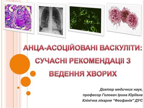 АНЦА асоційовані васкуліти сучасні рекомендації щодо менеджменту Ppt