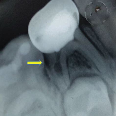 Dentin Bridge Formation In Teeth Treated With Theracal A And Mta B