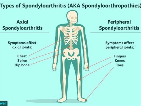 Ankylosingspondylitissymptoms