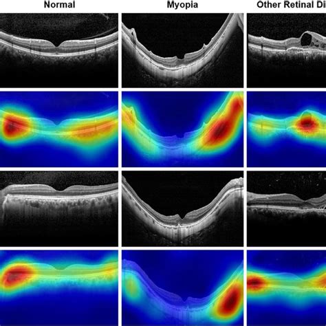 Visual Explanations Generated By Grad Cam On Oct Scans Of Myopia Download Scientific