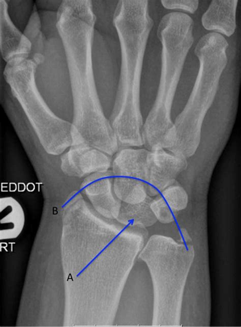 Lunate Dislocation