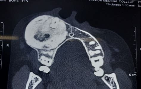 Axial Ct Showing Supernumerary Tooth Embedded Within The Tumor Mass