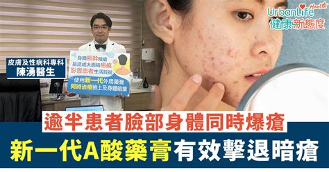 【暗瘡治療】逾半患者臉部身體均爆瘡 新一代維a酸藥膏有效治療