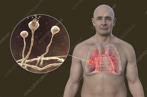 Man With Lung Mucormycosis Lesion Illustration Stock Image F0425393 Science Photo Library