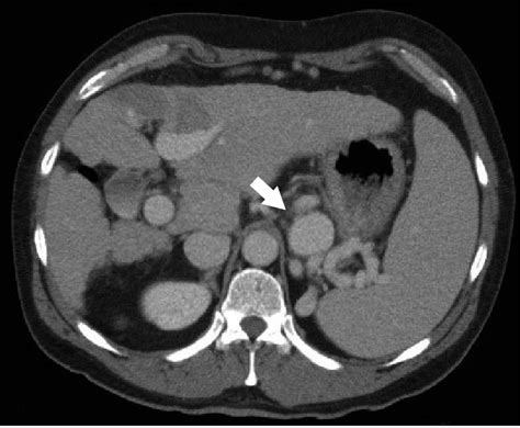 Axial Computed Tomography Image Depicting Cirrhosis Splenomegaly And
