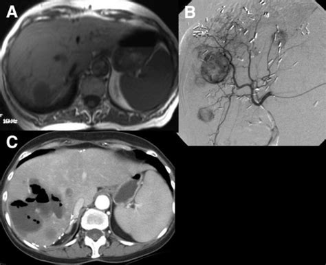 Treatment Of Metastatic Sarcoma To The Liver With Bland Embolization Maluccio 2006 Cancer