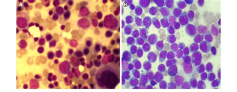 A Cellular Bone Marrow Aspirate Smears Showing Myeloblasts With