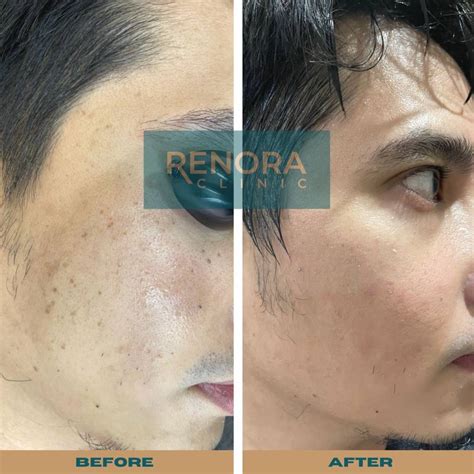 Kenali Jeragat Dan Rawatannya Renora Clinic
